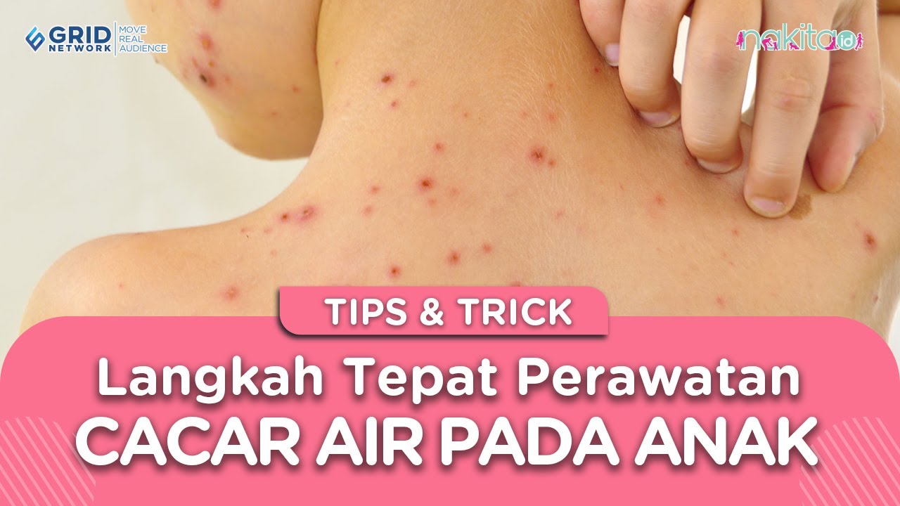 jangan-sampai-salah-jalan-ini-langkah-tepat-perawatan-cacar-air-pada