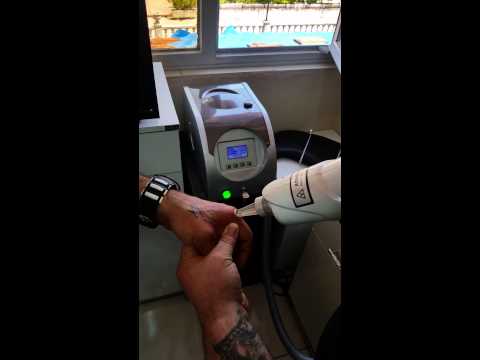 Lazerle dövme silme Hatay Antakya (Hakan Tattoo)