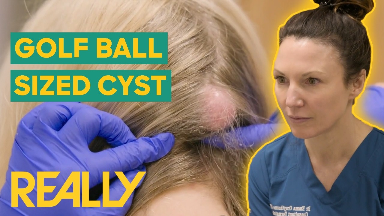 Dr. Emma Removes Golf Ball-Sized Cyst From Patient’s Scalp | The Bad ...