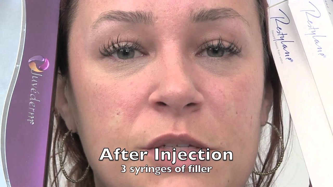 Immediately after injection Tear trough deformity by Dr. Goodnight ...