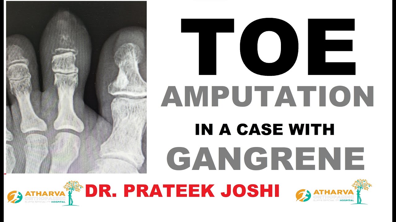 Toe Amputation | Diabetic Chronic Ulcer | Wet Gangrene | Chronic ...