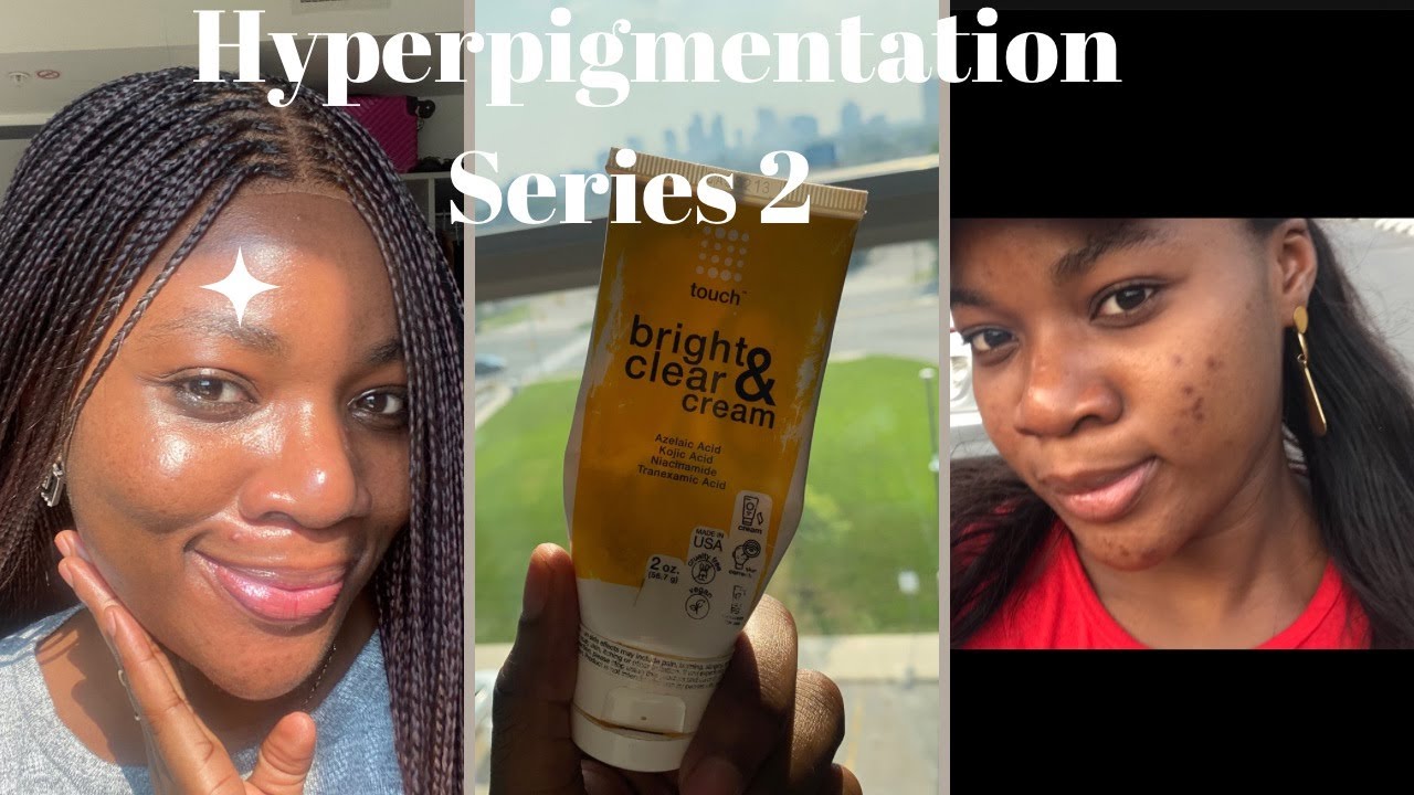 TOUCH BRIGHT & CLEAR CREAM REVIEW: DARK SPOTS & HYPERPIGMENTATION PRODUCTS. - YouTube