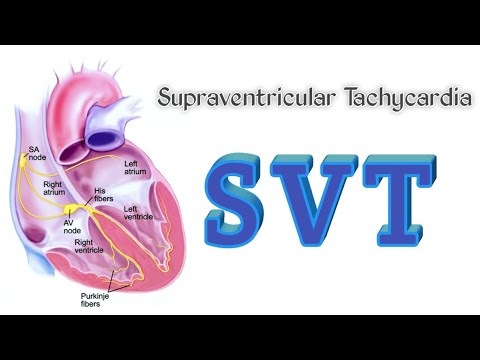 Supraventricular Tachycardia || AVNRT || AVRT - YouTube
