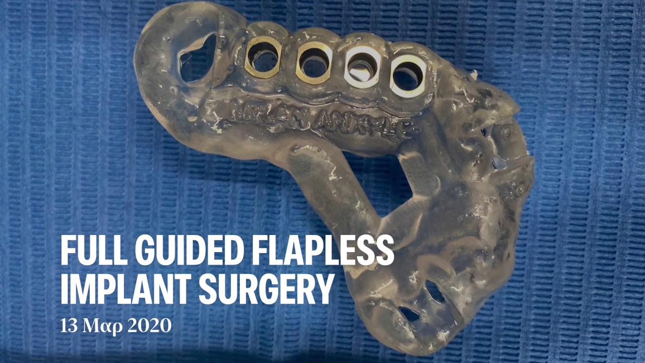 ΚΑΘΟΔΗΓΟΥΜΕΝΗ ΧΕΙΡΟΥΡΓΙΚΗ ΤΟΠΟΘΕΤΗΣΗ ΕΜΦΥΤΕΥΜΑΤΩΝ - GUIDED IMPLANT ...