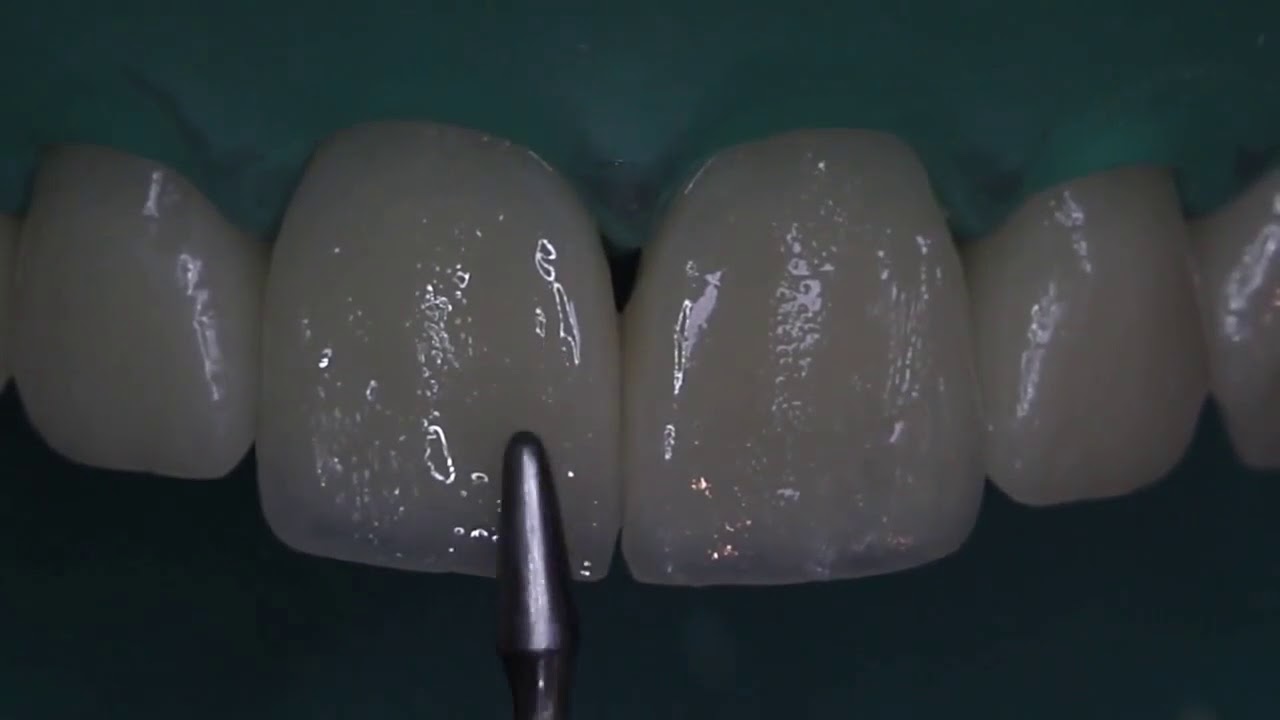 Restauración con resina compuesta en anteriores - YouTube