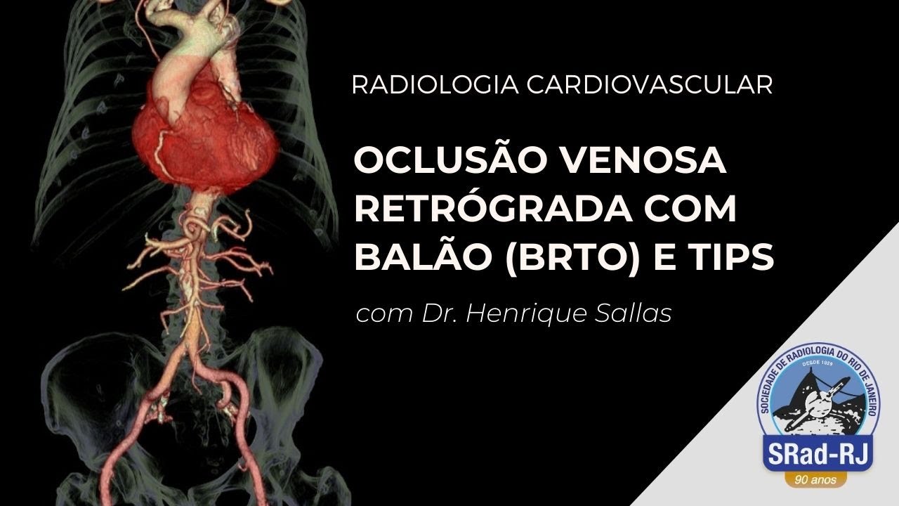 Oclusão venosa retrógrada com balão (BRTO) e TIPS - YouTube