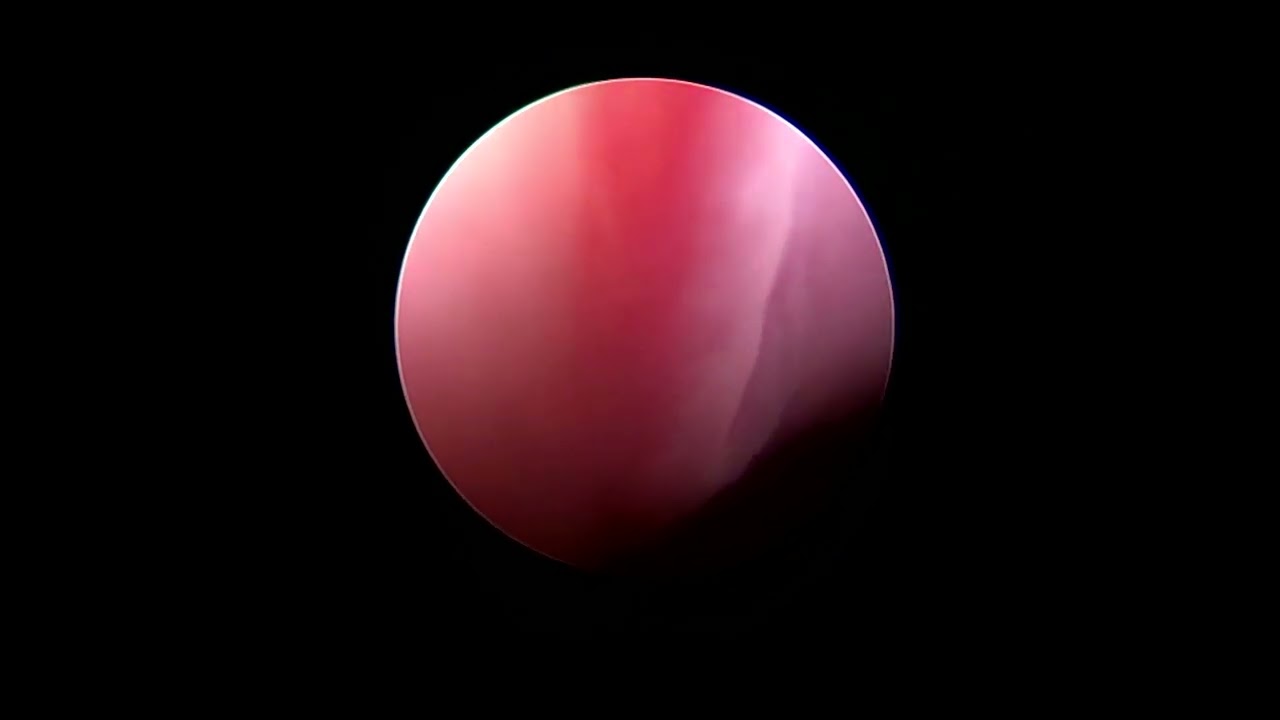 Cystoscope, ureteral opening, dog hematuria 膀胱鏡 尿管開口部 犬の血尿 - YouTube