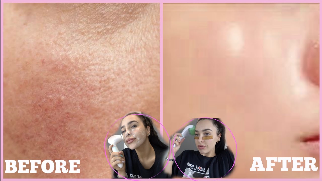 My Glowing Skincare Routine - How I Cleared My Skin Fast + Natural ...