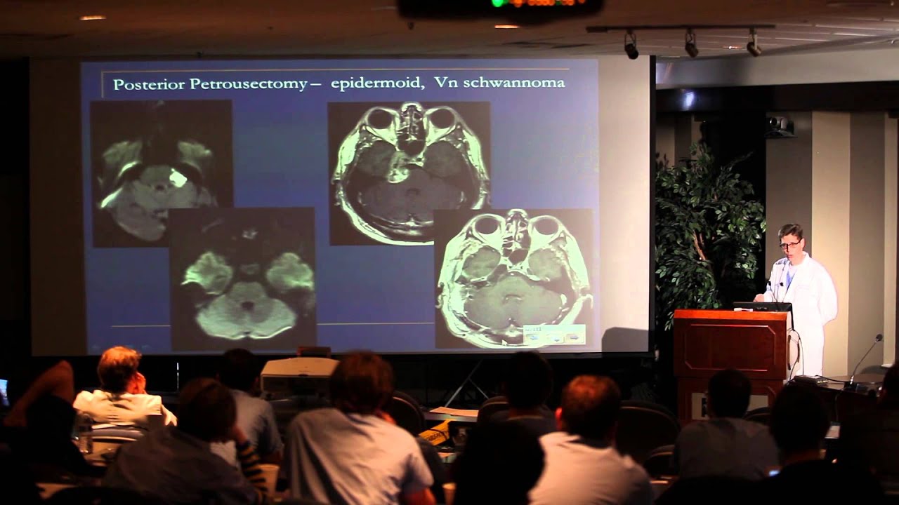 Designing a Posterolateral Skull Base Approach: Presigmoid vs ...