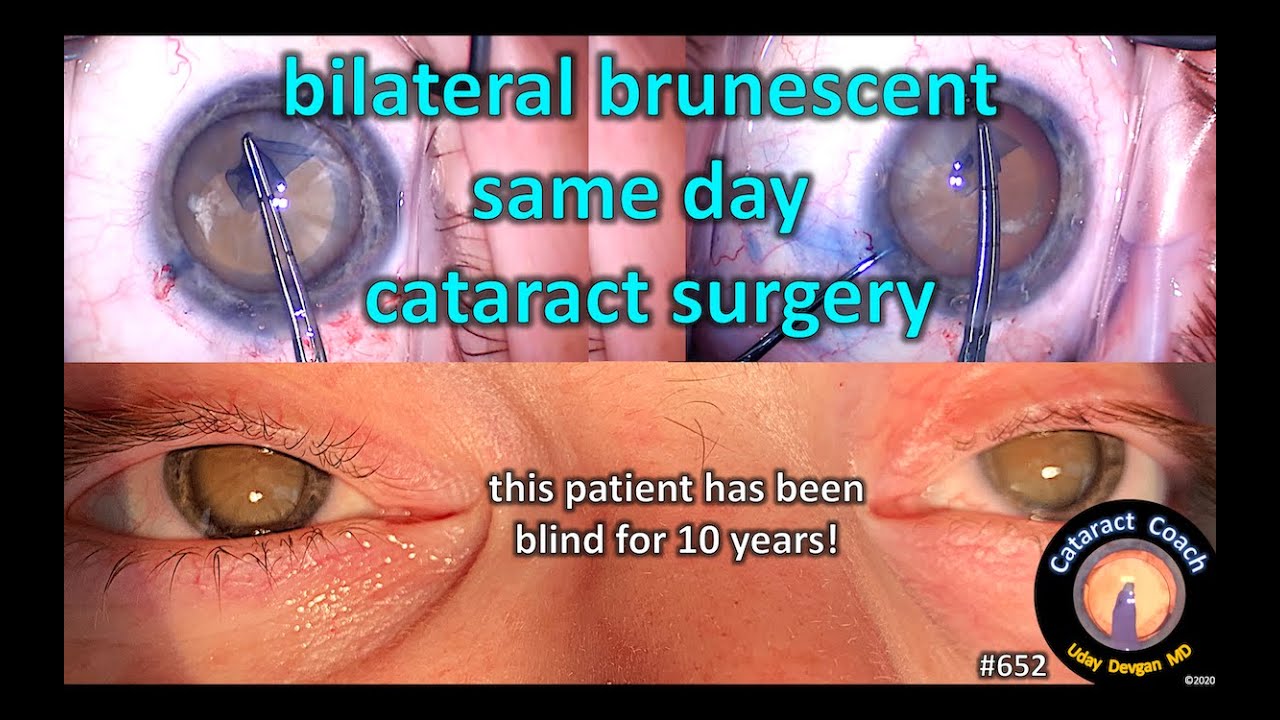 Bilateral Brunescent Same Day Cataract Surgery Youtube