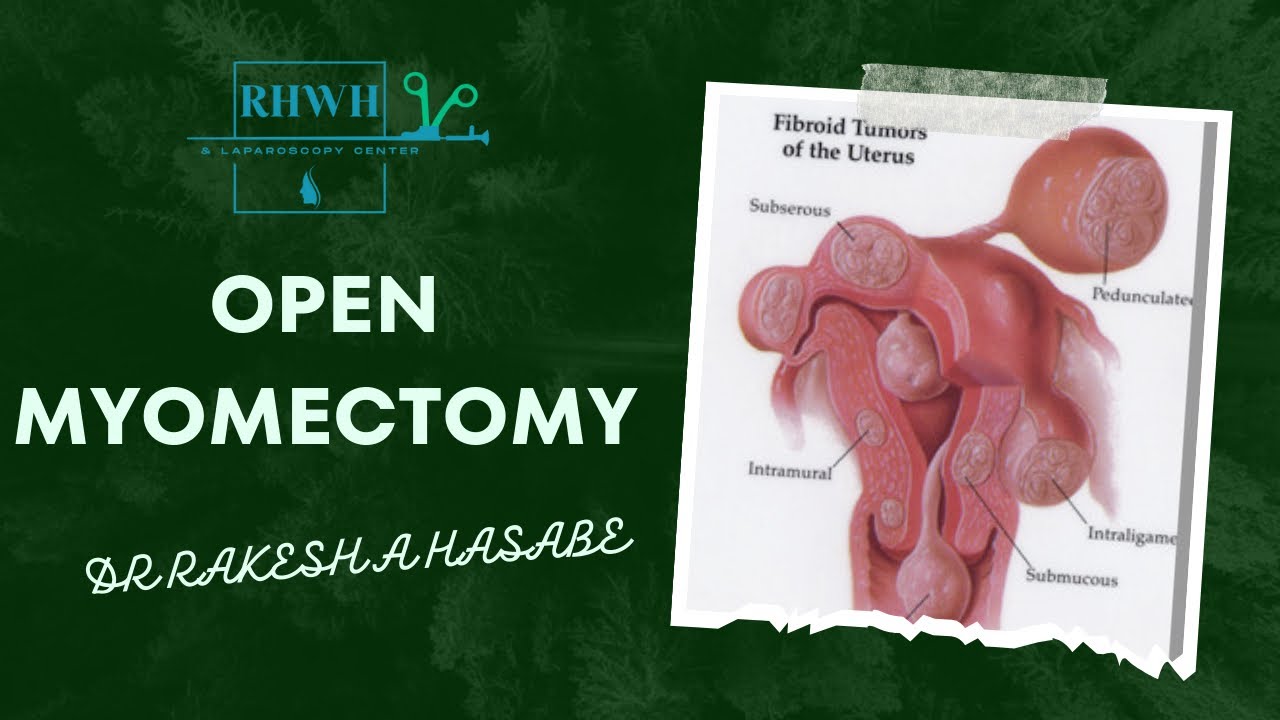 #206 : MASTERCLASS : HOW TO PERFORM OPEN MYOMECTOMY WITH BASEBALL ...