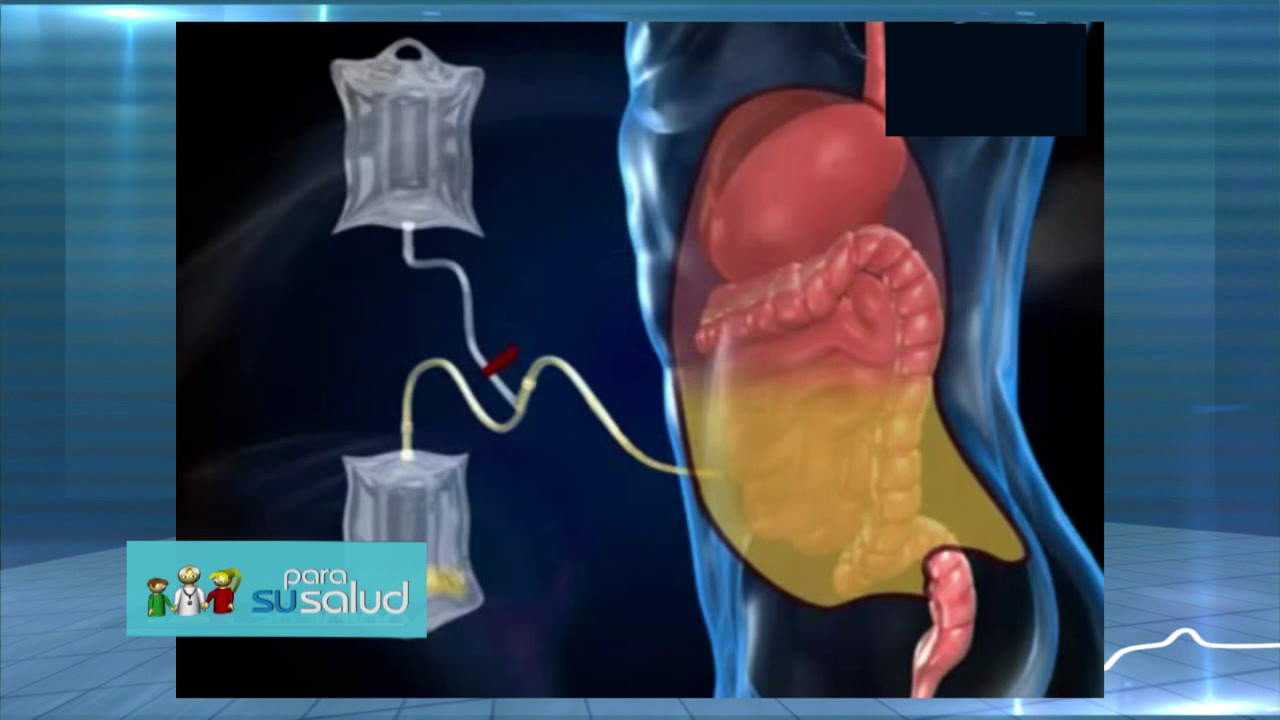 Dialisis peritoneal Dra Marcela Munizaga 01 09 2018 - YouTube