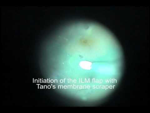 Combined phacoemulsification, PCIOL implantation and PPV with ILM ...