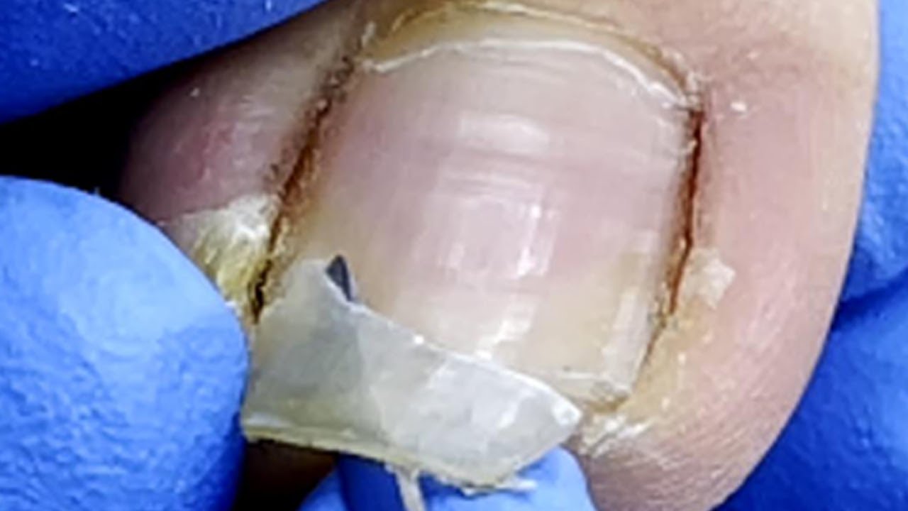 Pedicure Tutorial：Minor paronychia treatment trimming【Pedicure Master ...