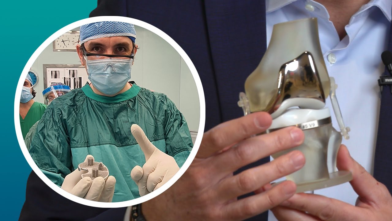 [LimaCorporate] 3D printing helps pioneer cementless knee replacements ...