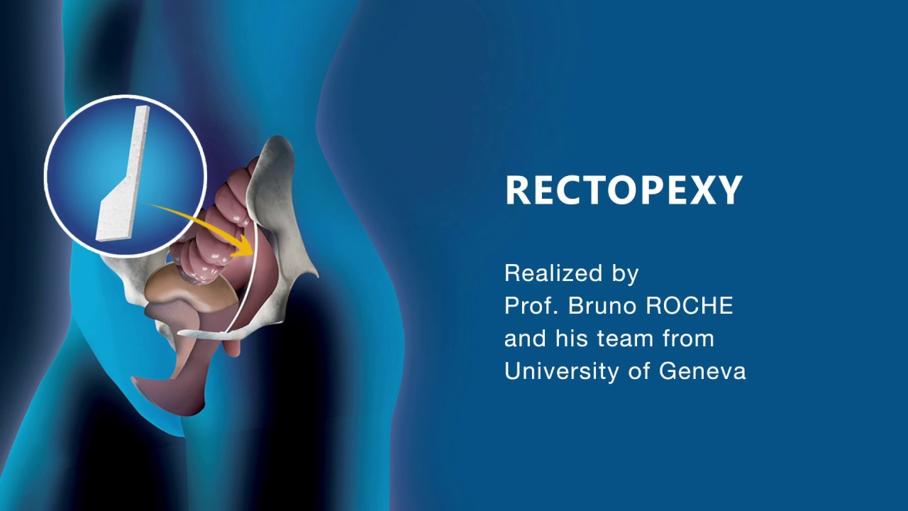 CELLIS® Rectopexy - YouTube