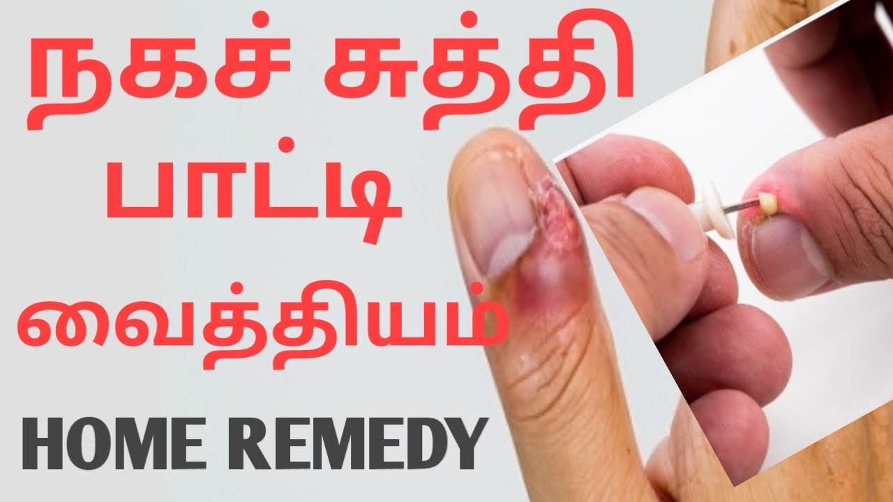 Nagasuththi treatment in tamil/Naga suthi Patti vaithiyam tamil/Naga ...