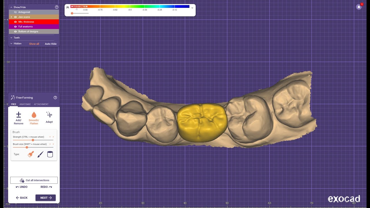 Lower molar designing in Exocad - YouTube