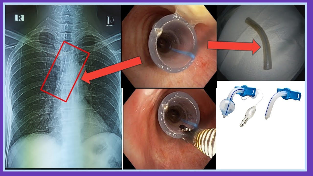 Displaced Tracheostomy Tube Removal l ফুসফুস থেকে ট্র্যাকিওস্টোমি টিউব ...