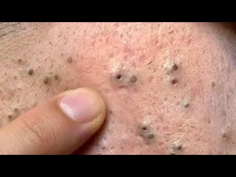 sac be spa blackhead elderly men face  |sac be spa men face blackhead new 2026 | StepbyStep new #555