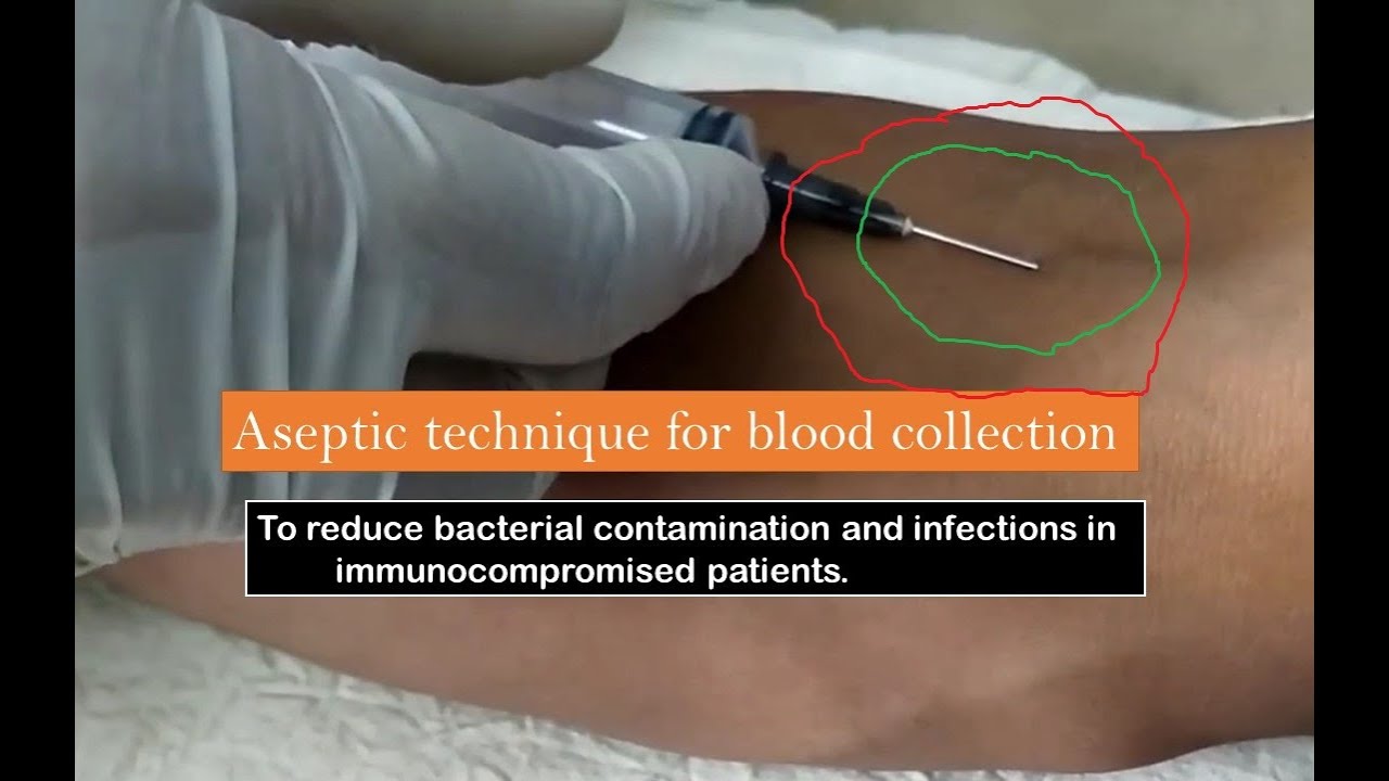 Aseptic technique for blood collection and its significance in ...