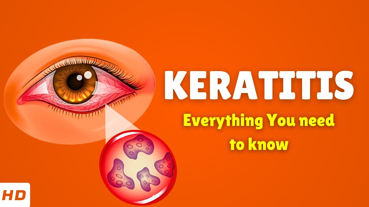 Keratitis – Causes, Types, Signs and Symptoms, Diagnosis & Treatment ...