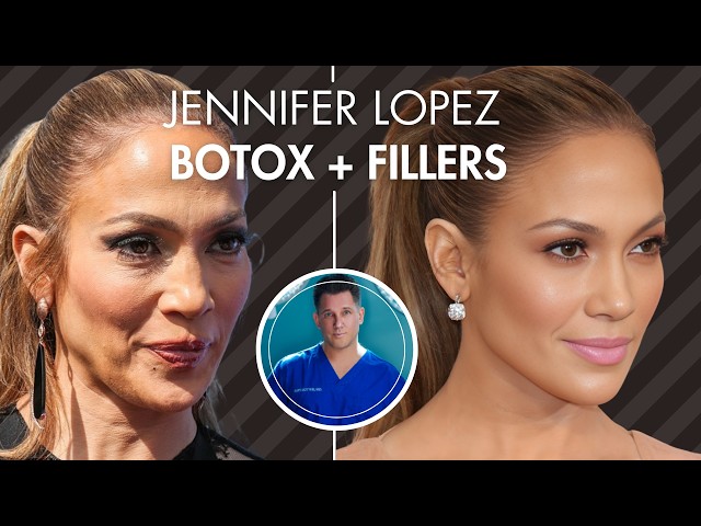 Jennifer Lopez Botox Antes Depois