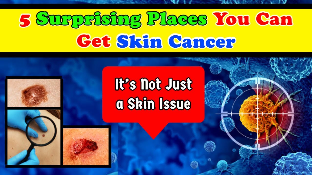 Which Body Parts are Target of Skin Cancer - YouTube