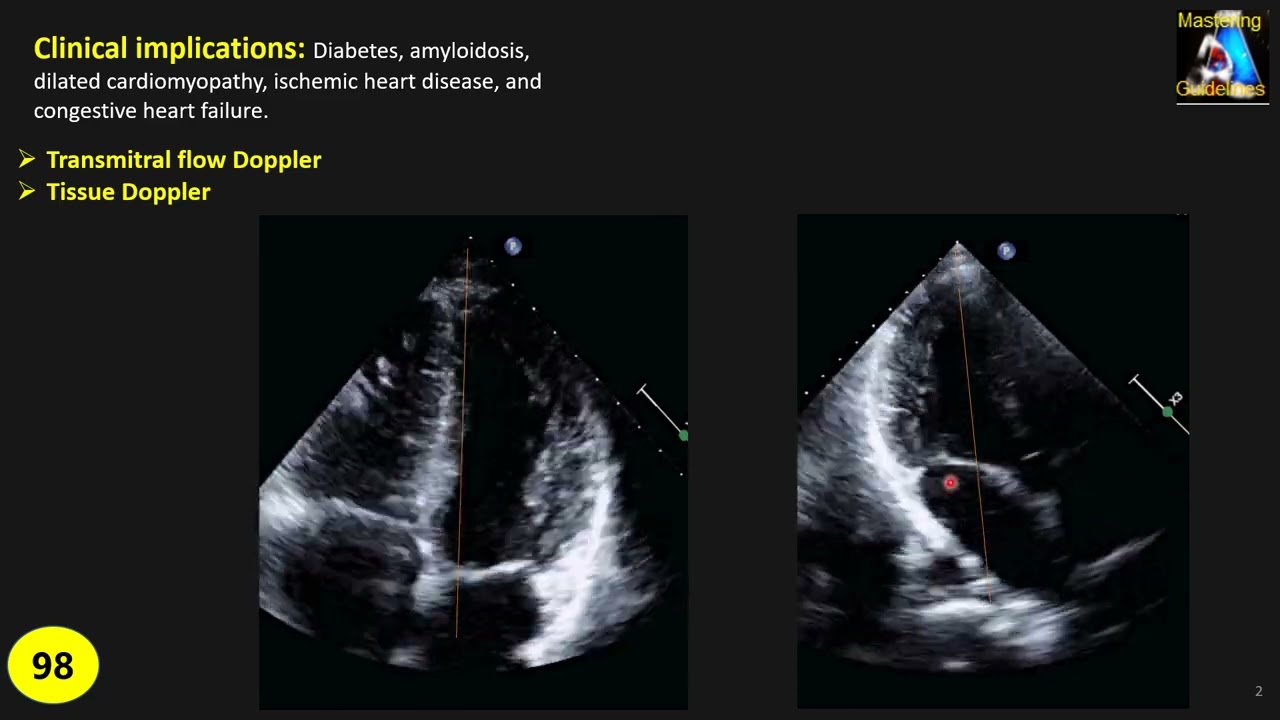 Tips & Mistakes: Tei Index (Myocardial Performance Index) - YouTube