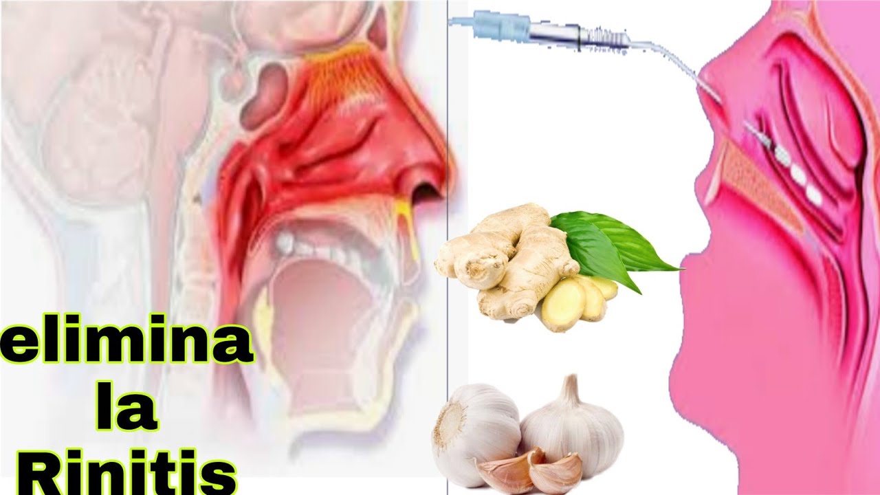 Como curar la Rinitis/la moscosidad - YouTube