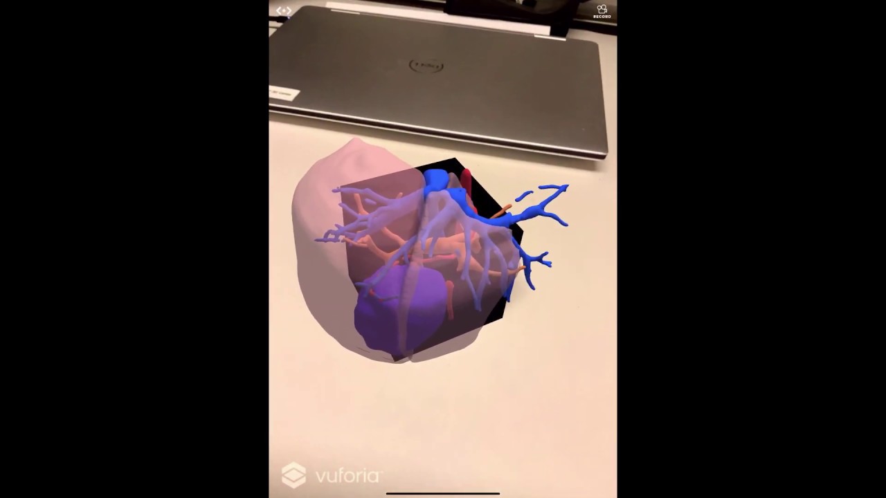 Liver Tumor model in Augmented Reality - YouTube