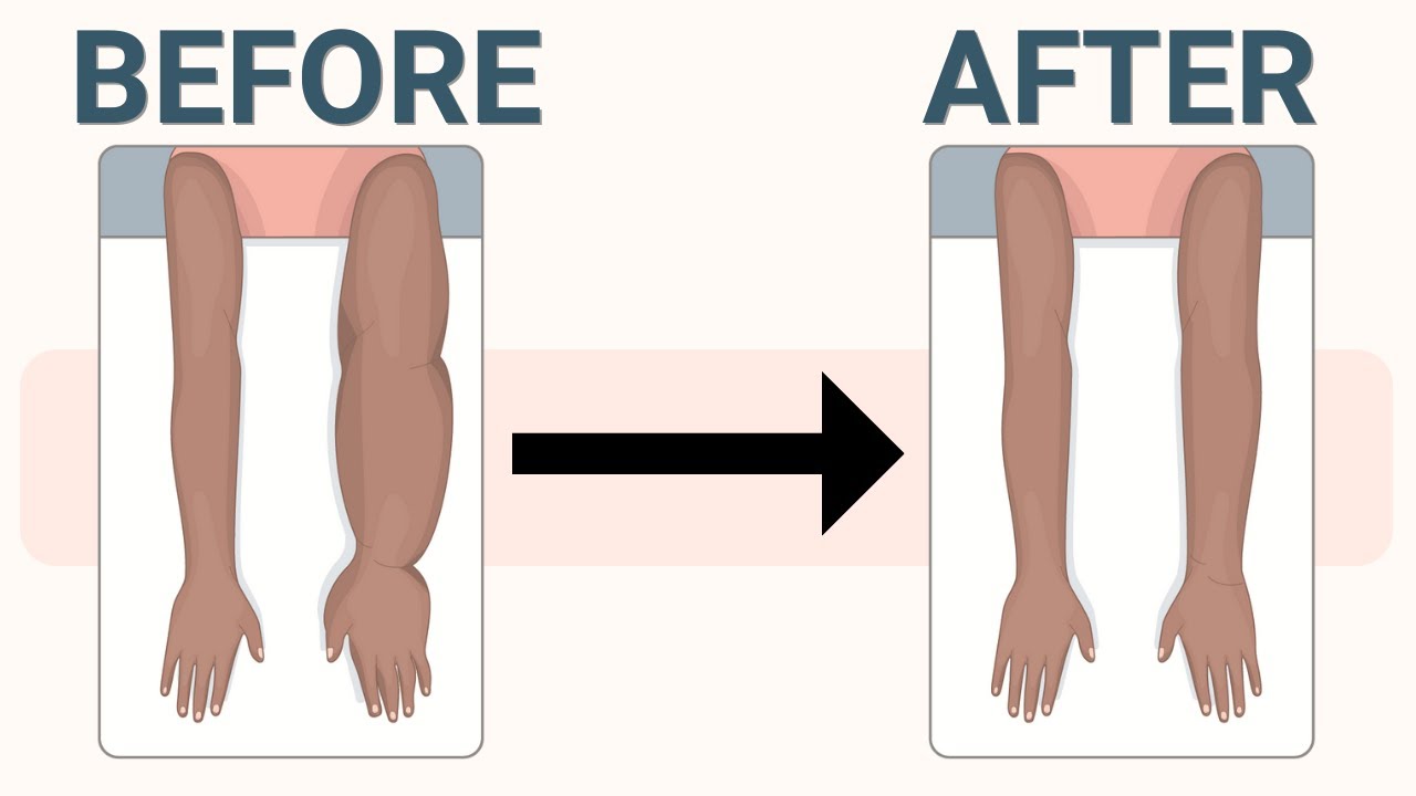 Treatment for Arm Lymphedema and Swelling after Cancer Surgery - YouTube