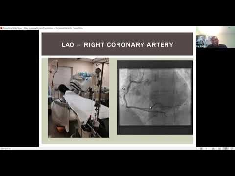 Coronary Angioplasty - Cath Lab procedure - YouTube