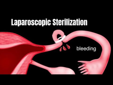 Laparoscopic tubal ligation using Fallope ring - YouTube