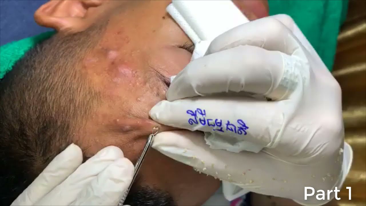 Part 2: Satisfying Relaxing Best Video with Win Spa blackhead - YouTube