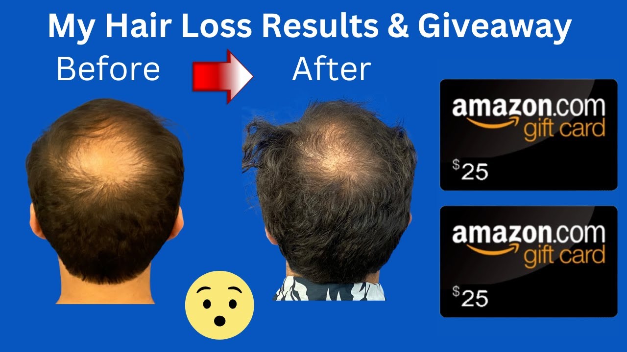 Finasteride Minoxidil Crown Regrowth & Amazon Gift card Giveaway - YouTube