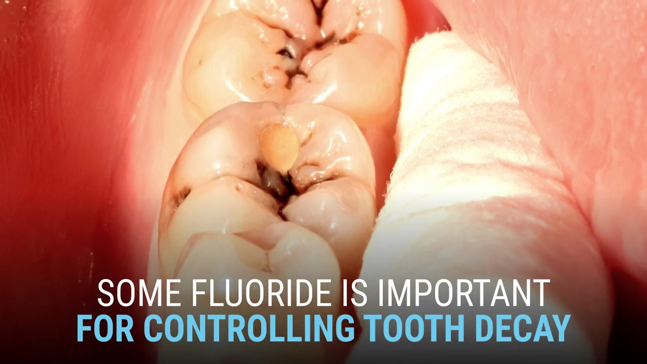 What Is Dental Fluorosis YouTube