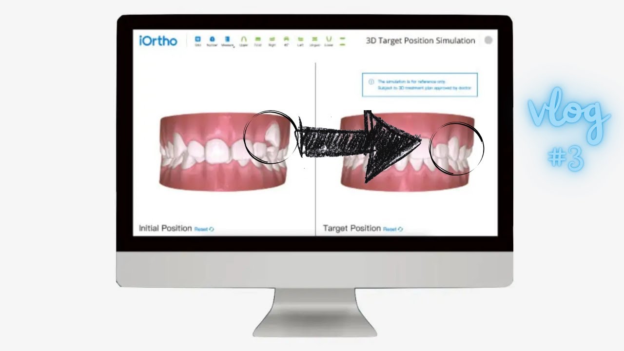 Escáner 3D iOrtho. Estudio y toma de registros. Angel Aligner Pro ...