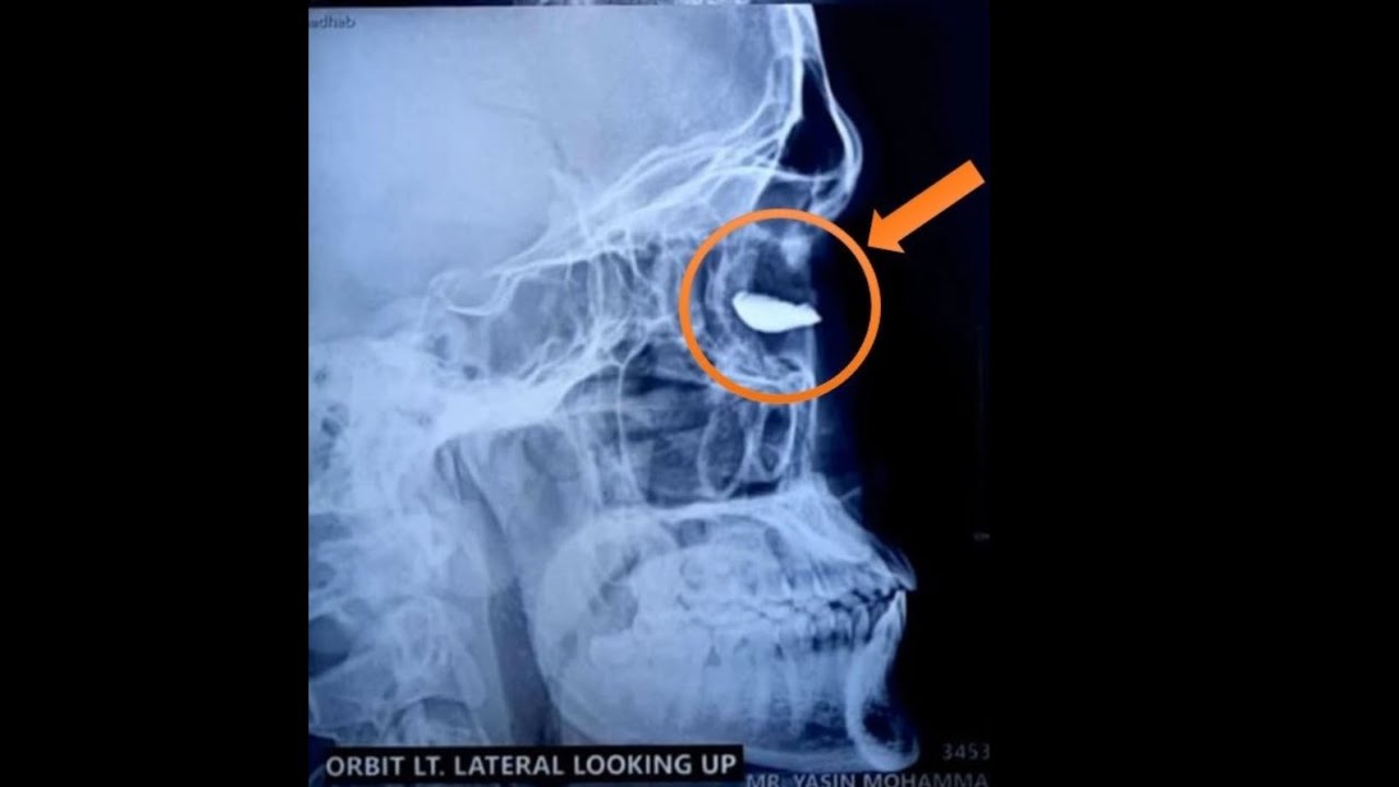 Removal of intraocular large metalic foreign body by Dr Billal Hossain ...