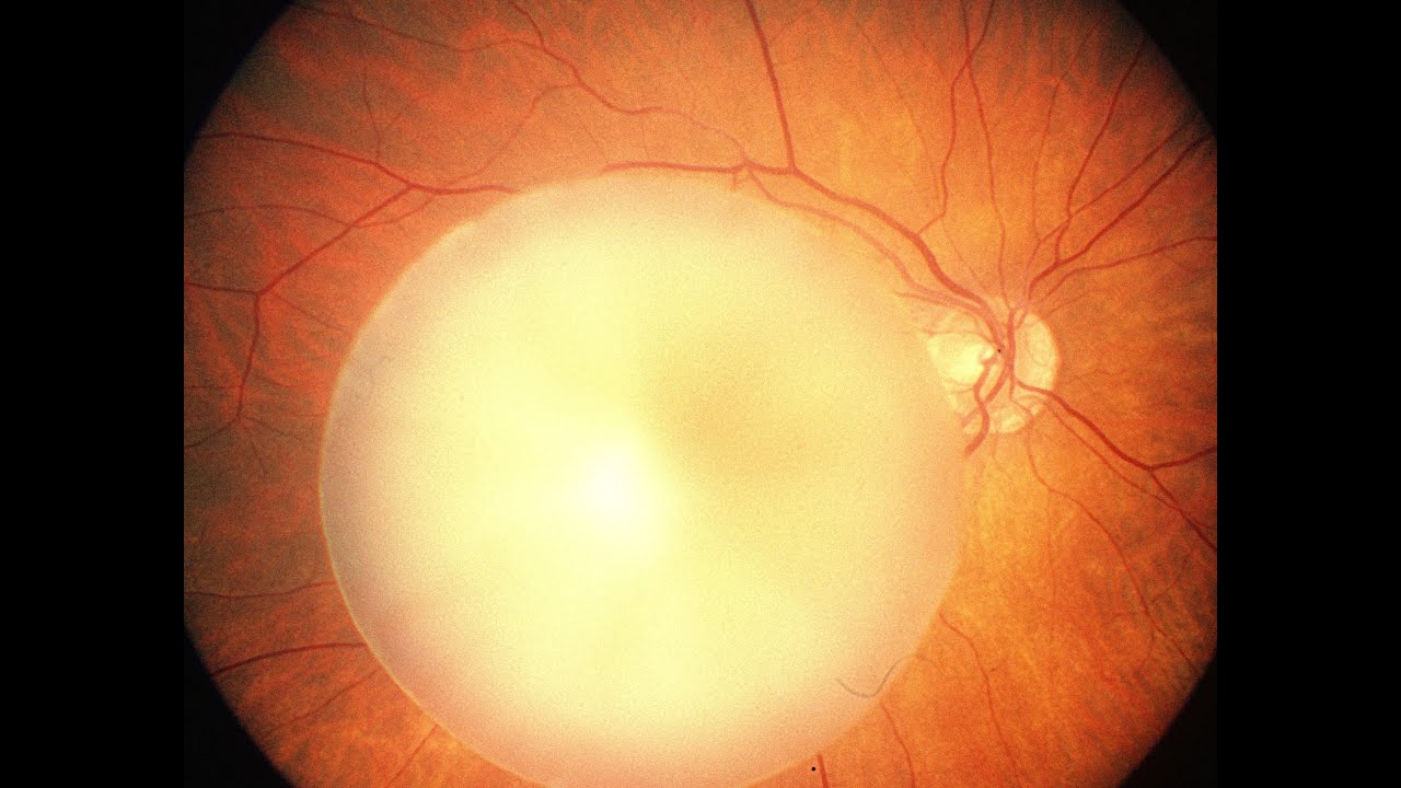 Management of dropped nucleus - YouTube