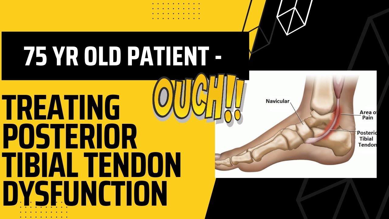 75 Year Old Patient with Posterior Tibial Tendon Dysfunction & How we ...