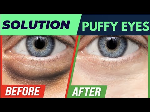How do you get rid of a puffy face fast? - YouTube