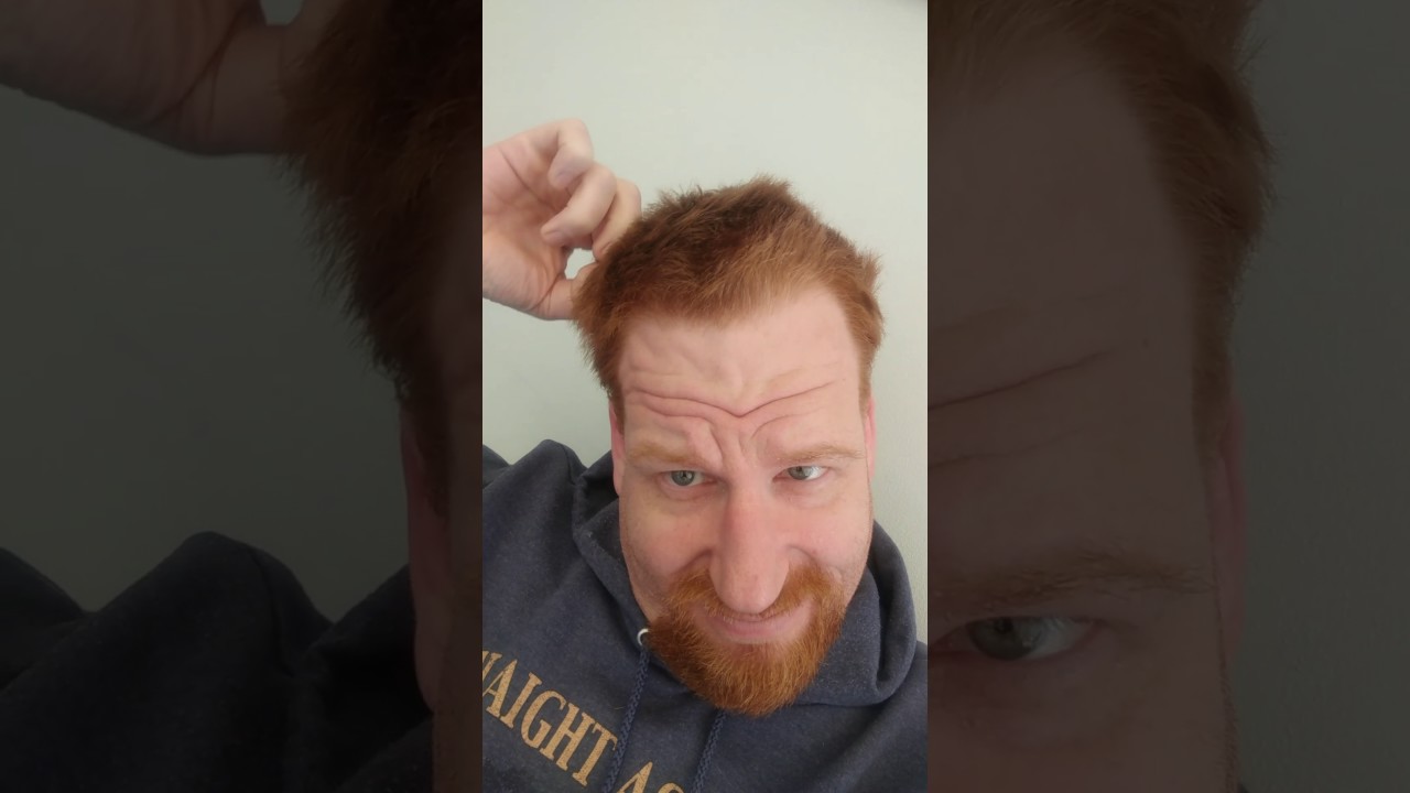 Hair Pulling Disorder Firsthand Video YouTube