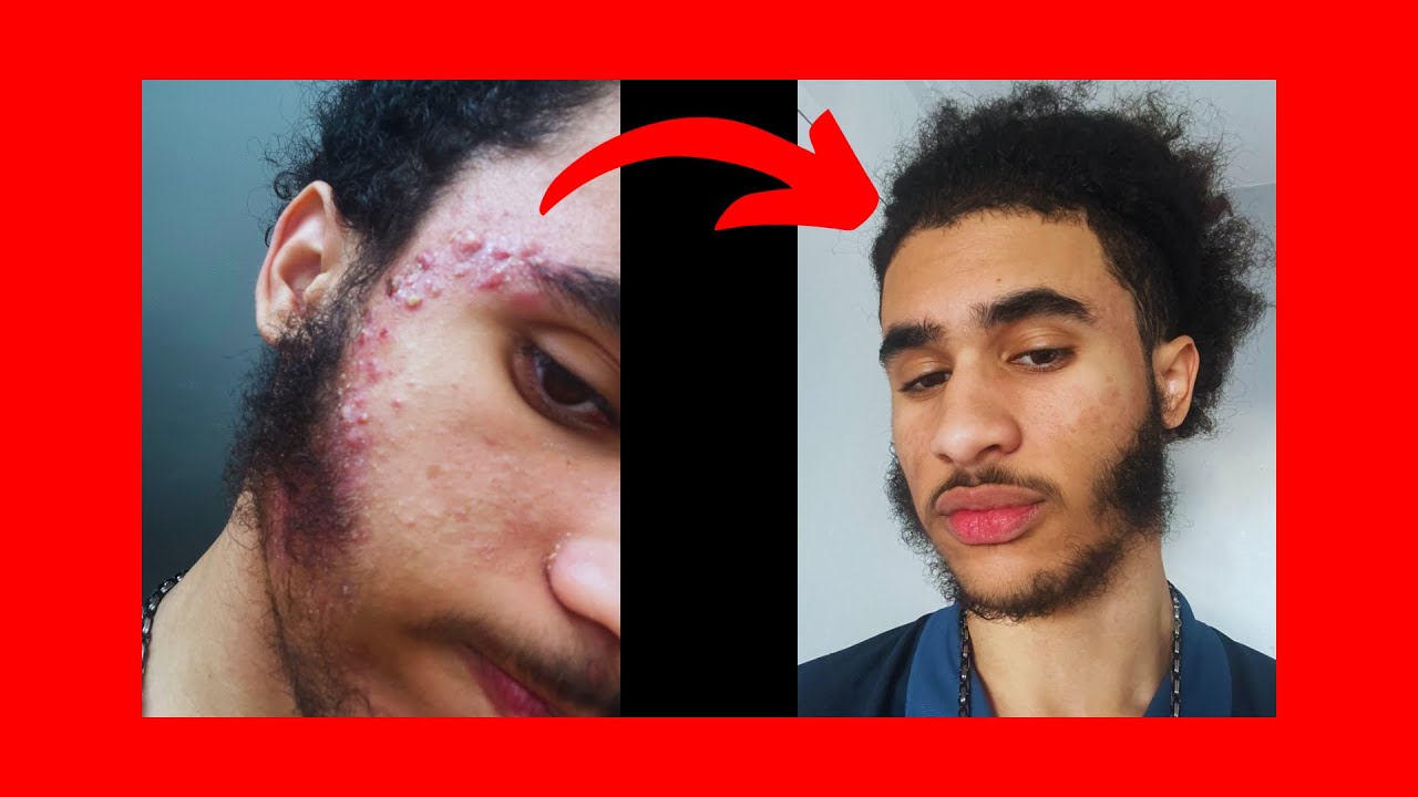 My Acne Was Really Bad **My Transformation** - YouTube