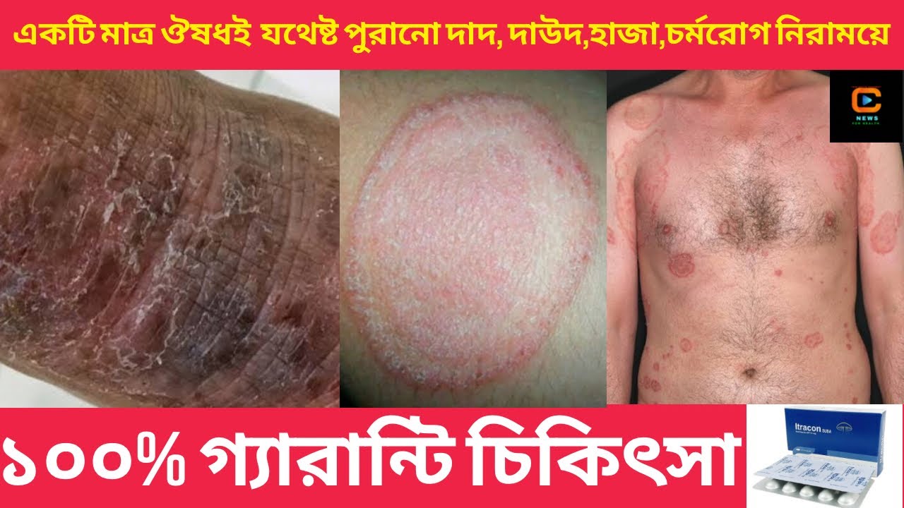 dadar osud/dader osud/দাদের ঔষধ/দাউদের ওষধ/চর্মরোগের ঔষধ/daraj skin ...
