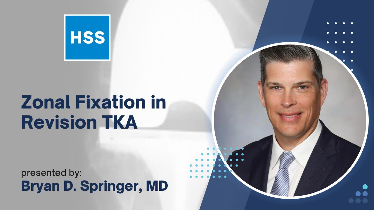 Zonal Fixation in Revision TKA - Bryan D. Springer, MD - YouTube