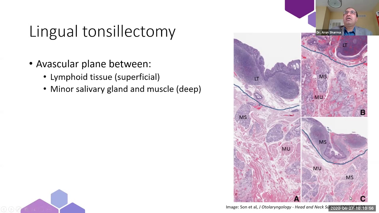 Management of Unknown/Occult Primary SCC - Dr. Arun Sharma - YouTube