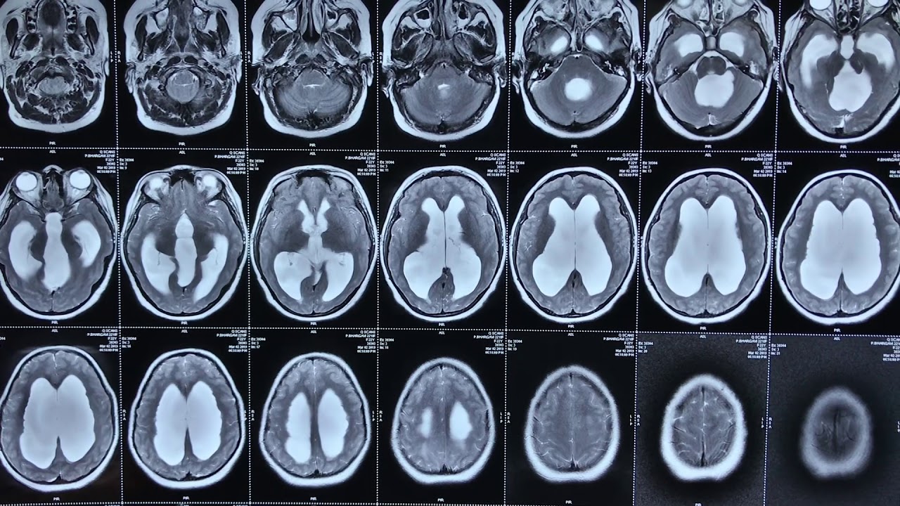 ETV | Endoscopic third Ventriculostomy | Hydrocephalus | Congenital ...