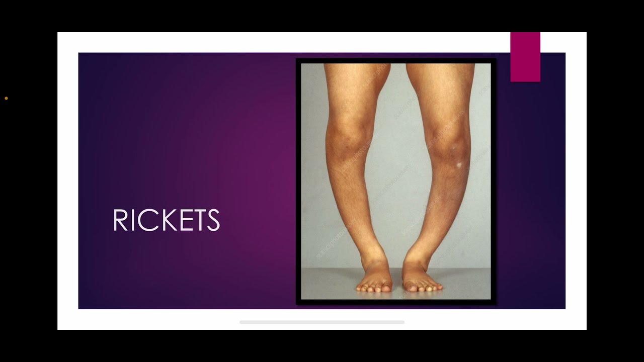 Rickets: symptoms, causes and treatments - YouTube