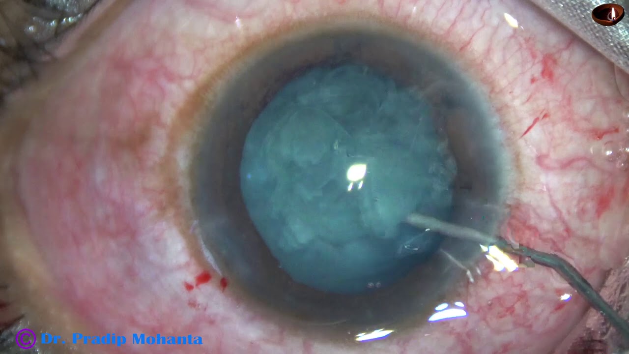 Cataract with Zonular Tear plus Vitreous in AC subsequent to Blunt ...